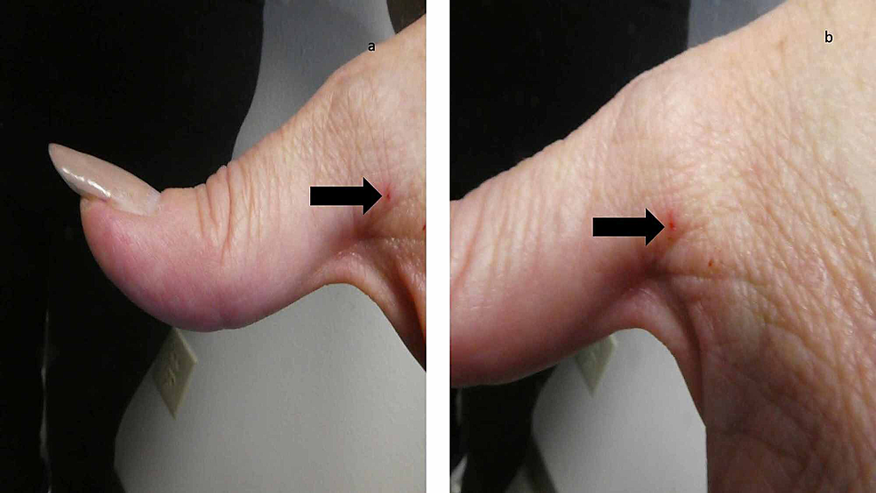 Scabies Rash On Hands